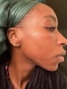 The 3D MIRACL: Trying Out The Famous "Cold" Fractional Laser