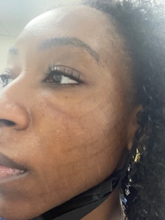 The 3D MIRACL: Trying Out The Famous "Cold" Fractional Laser