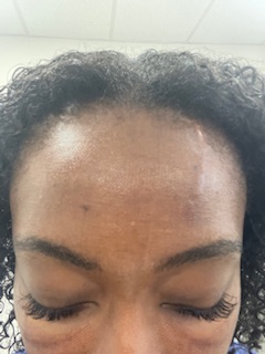 The 3D MIRACL: Trying Out The Famous "Cold" Fractional Laser