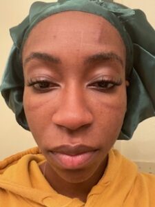 The 3D MIRACL: Trying Out The Famous "Cold" Fractional Laser