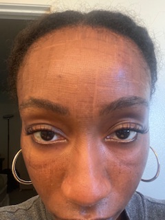 The 3D MIRACL: Trying Out The Famous "Cold" Fractional Laser