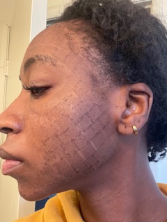 The 3D MIRACL: Trying Out The Famous "Cold" Fractional Laser