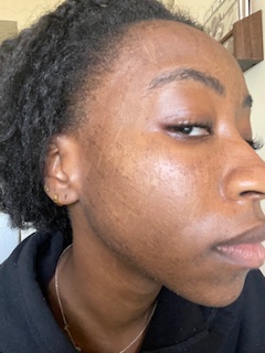 The 3D MIRACL: Trying Out The Famous "Cold" Fractional Laser