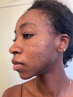 The 3D MIRACL: Trying Out The Famous "Cold" Fractional Laser