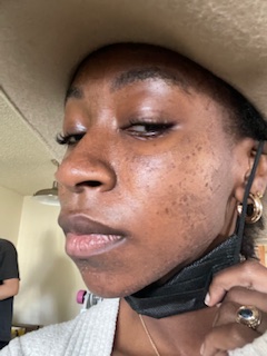 The 3D MIRACL: Trying Out The Famous "Cold" Fractional Laser